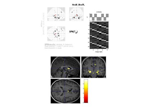 11 Fmri Results Double Interaction H Vs M X M Vs Pl The Brain