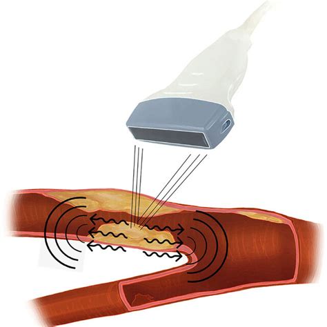 Schematic Image Illustrating The Shear Wave And Its Propagation