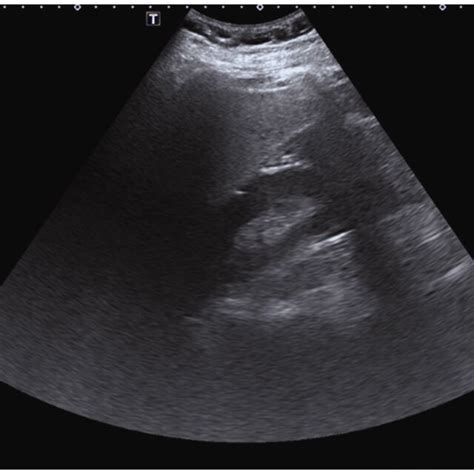 Histopathological Examination A Polymorphous Infiltrate Of Download Scientific Diagram