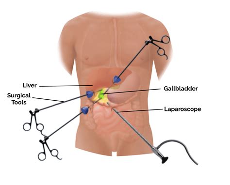 Cholecystectomy Laparoscopic Surgery