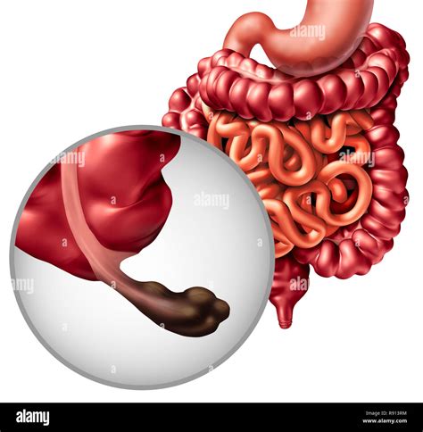 What Causes Appendix Cancer