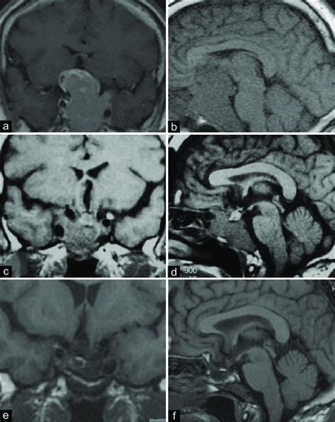 Magnetic Resonance Imaging Of Pituitary Adenoma A And B Before The Download Scientific