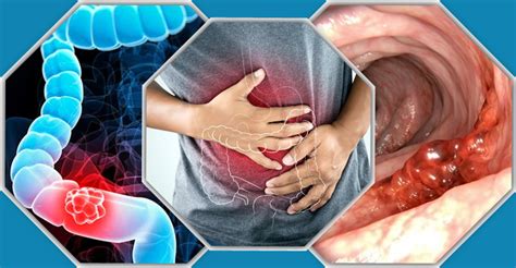 কোষ্ঠকাঠিন্য হতে পারে যে ক্যানসারের লক্ষণ