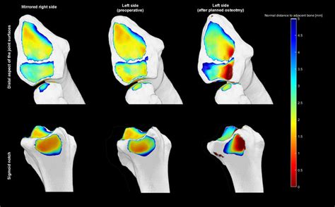 Simulation Of The Postoperative Situation Using Distance Mapping Dark