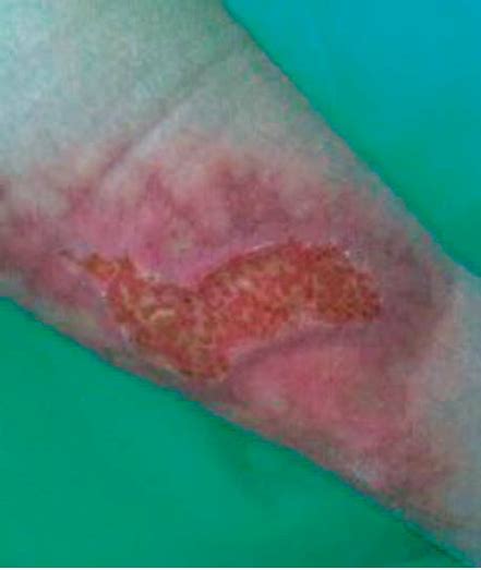 Healed Pyoderma Gangrenosum Download Scientific Diagram