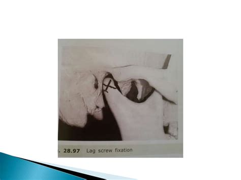 Condylar Fracturepptx