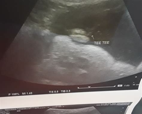 Babe Or Girl Ultrasound Wrong Gender Scan Accuracy