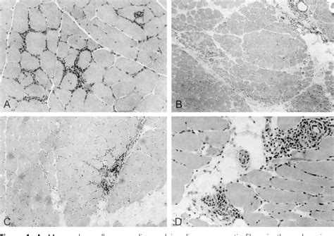 Polymyositis Semantic Scholar