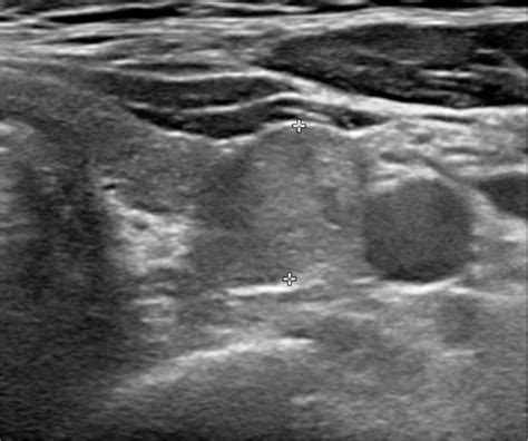 Validation Of Tirads Acr Risk Assessment Of Thyroid Nodules In Comparison To The Ata Guidelines