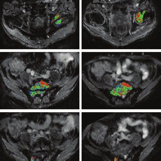 Functional Diffusion Maps Regional Changes Of ADC Are Plotted On The Download Scientific