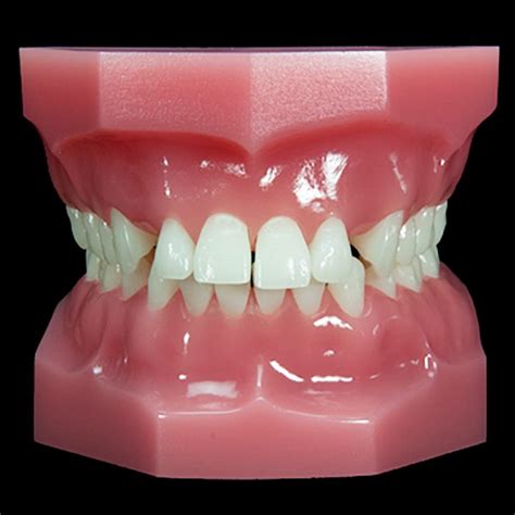 Or 11c Class I Crowded Enmasse Retraction Paradigm Dental Models