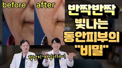 프리미엄 물광주사 바이리즌 동안 시술의 끝판왕 Youtube