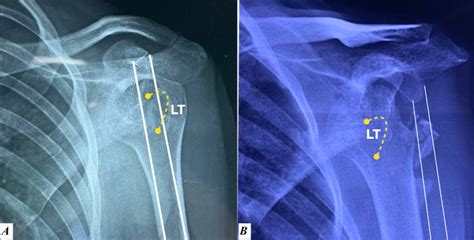 Xray Shoulder Dislocation