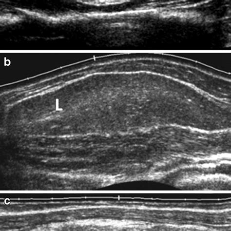Pdf Ultrasound Features Of Deep Seated Lipomas