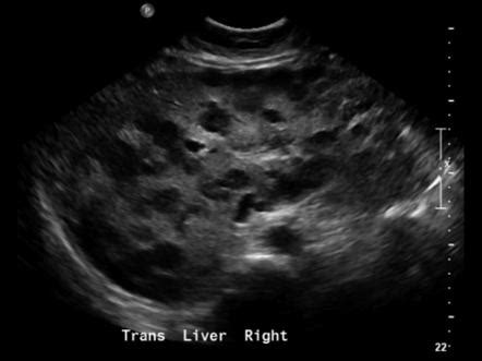Primary Hepatic Diffuse Large B Cell Lymphoma Radiology Case Radiopaedia Org