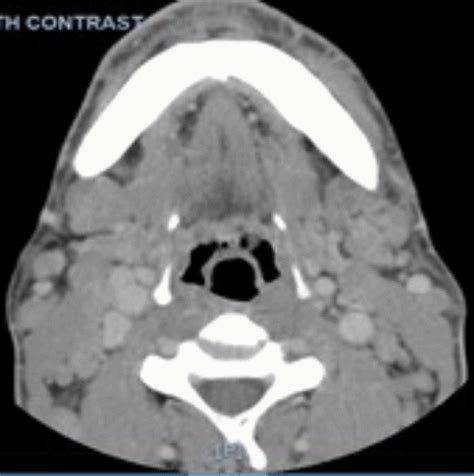 Acute Tip Appendicitis In The Setting Of Newly Diagnosed Adult T Cell