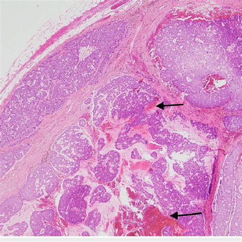 Large Circumscribed Nodular Tumor Occupying Almost Full Thickness Of Download Scientific