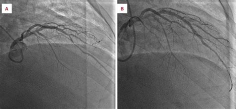 A Angiogram During The First Pci Showing A Stenotic Lesion In The Download Scientific Diagram