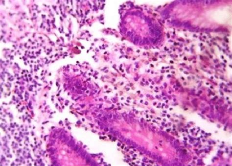 A Characteristics Of Appendix Show Increased Eosinophilic Download Scientific Diagram A Characteristics Of Appendix Show Increased Eosinophilic Download Scientific Diagram