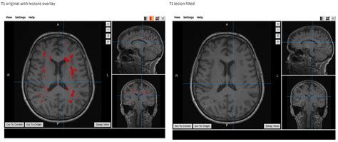 Lesion Segmentation Workflow