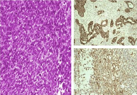 Histopathological Slide Of Teratocarcinosarcoma With Download