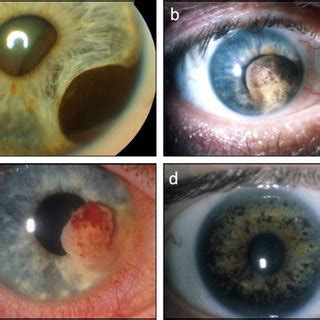 PDF Ocular Melanoma