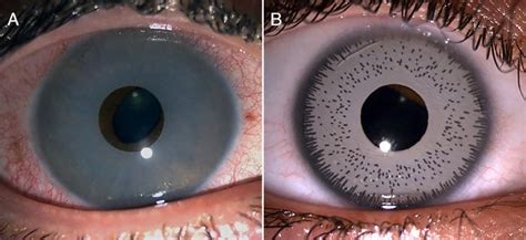 These Unnatural Eye Color Implants Roddlyterrifying