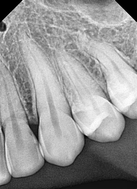 Toothpulpdetect Instance Segmentation Model By Toothpulp04022025