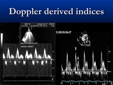Echocardiographic Evaluation Of Lv Function Ppt