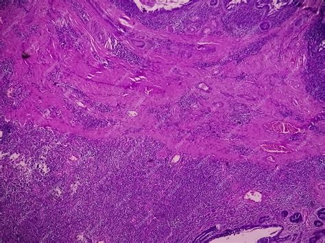 Premium Photo Histological Slide Under Microscopy Showing Pedunculated Squamous Papilloma