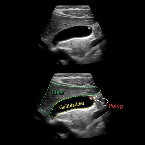 Daniel Ben Mordechay On Linkedin Ultrasound Pocus Gallbladder Gallbladder Polyp