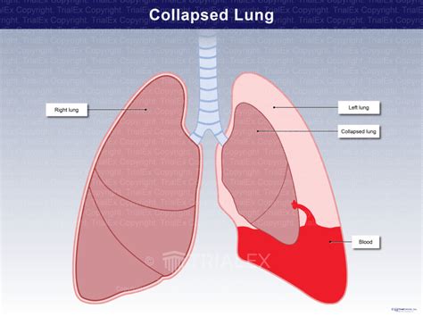 Collapsed Lung Hemothorax Trialquest Inc