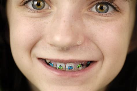 Smiling With Braces Stock Photo Image Of Smile Fixing 8191266