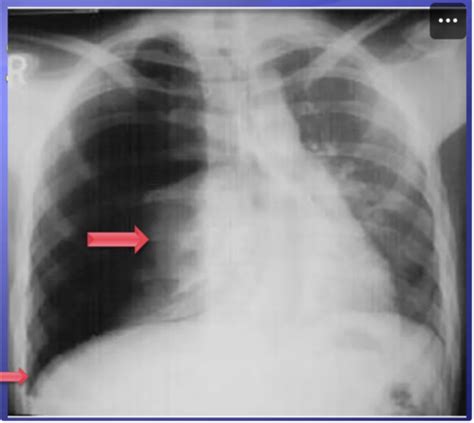 Pathophysiologyresp Pneumothorax Flashcards Quizlet