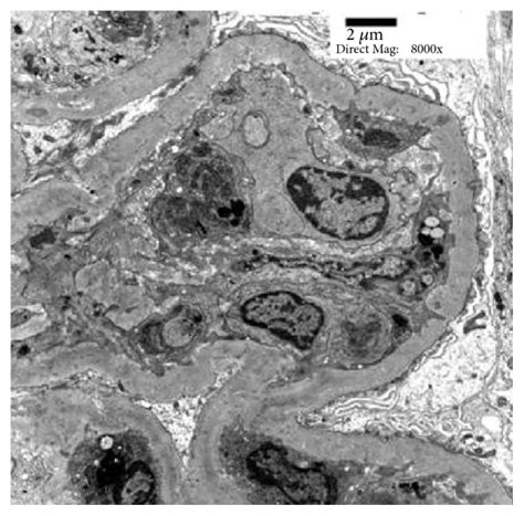 Post Streptococcal Glomerulonephritis Psgn Renal System Renal