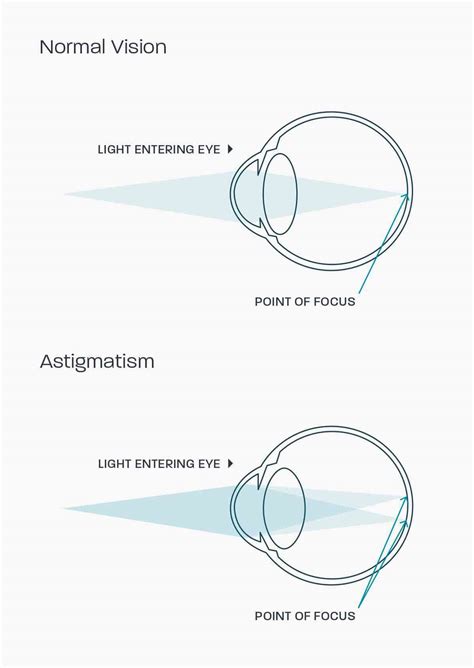 Astigmatism Causes Types Symptoms Treatment 58 Off