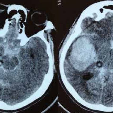Workup Of A Patient With Hyponatremia Based On Data From 38 98 Na
