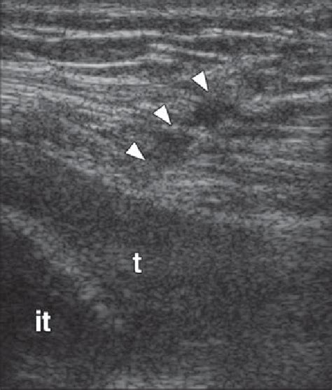 Year Old Man With Proximal Hamstring Tendinopathy Sagittal Ultrasound