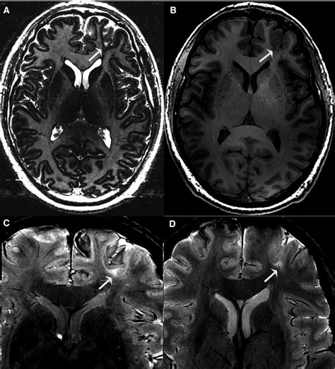 Ultra High Field 7 Tesla Mri Of Fcd Type Iib Tissue Border