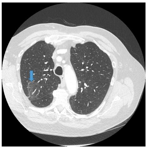Incidental Ill Defined Nodular Lung Opacities Discovered During Ct