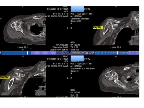 Shoulder And Elbow Surgery Reverse Shoulder Replacement For Proximal