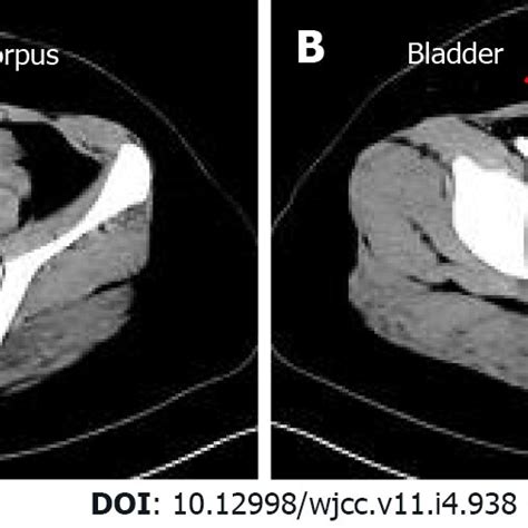 Computerized Tomography Imaging A Uterine Body B Lower Uterine Download Scientific Diagram