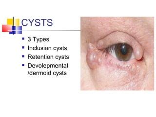Pathology Of Eyelids And Adnexa Ppt