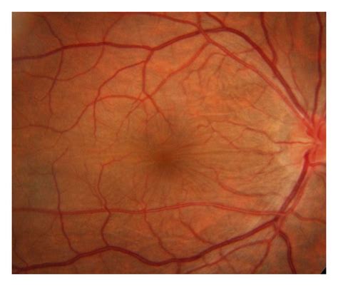Fundus Photographs And Optical Coherence Tomographic Images In A