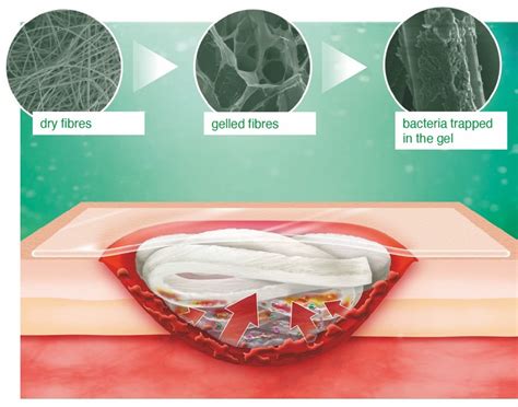 Suprasorb® Wound Care Today