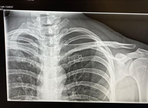 My X Ray Minus A First Rib Thanks Thoracic Outlet Syndrome R Radiology