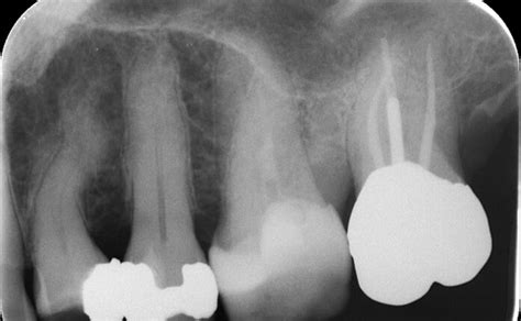 Calcified Root Canals Andy Tsai Endodontics