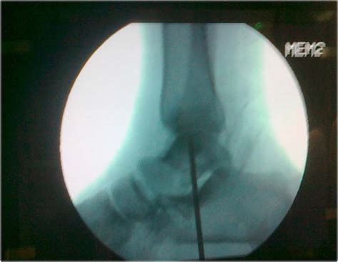Lateral Subtalar Dislocation Of The Foot A Case Report The Foot And Ankle Online Journal