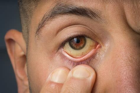 Man Checking Yellow Eyes High Bilirubin Level Cirrhosis Or Hepatitis