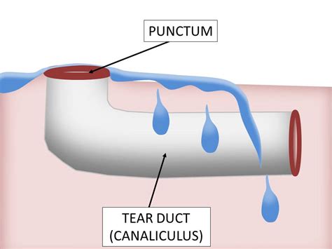 Punctoplasty Jonathan Norris